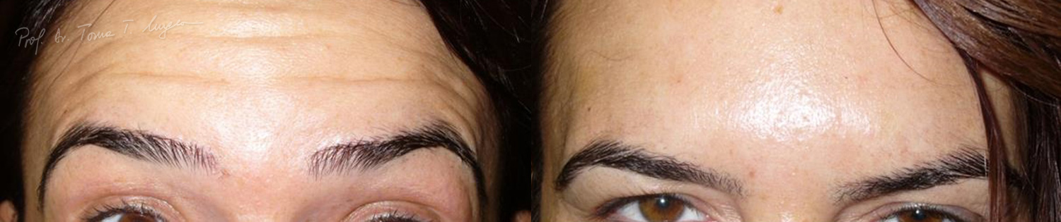 Galerie foto - Tratament Glycon