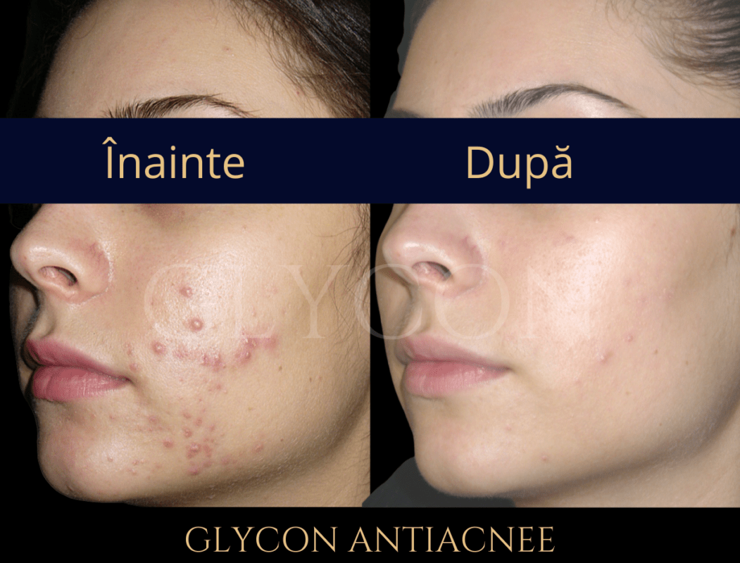 Gama de produse profesionale Glycon cu acid glicolic