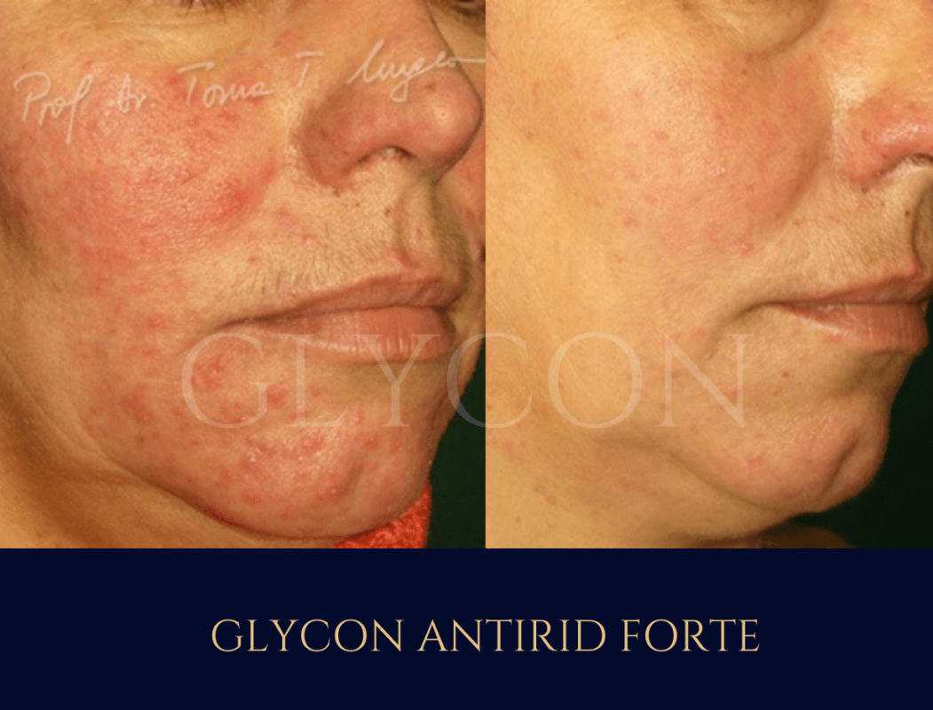 Gama de produse profesionale Glycon cu acid glicolic