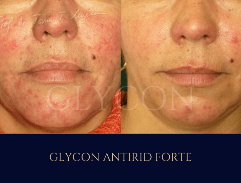 Gama de produse profesionale Glycon cu acid glicolic