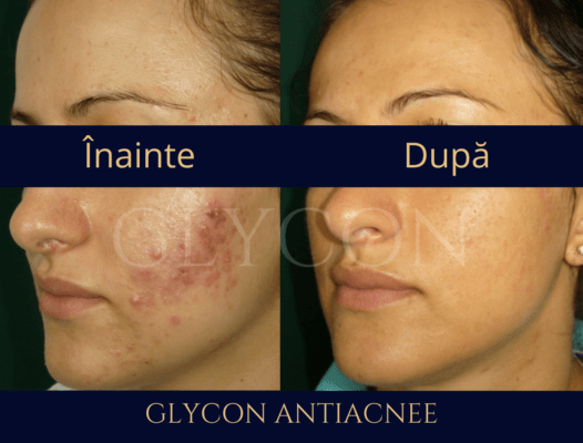 Gama de produse profesionale Glycon cu acid glicolic