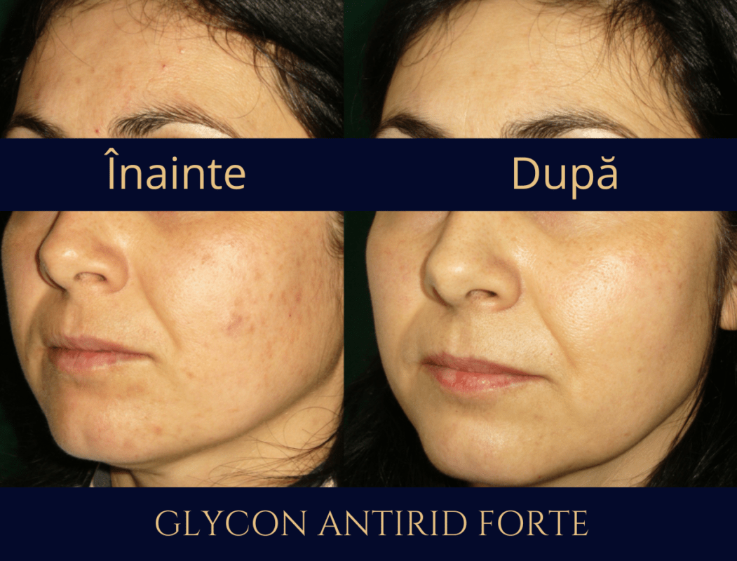 Gama de produse profesionale Glycon cu acid glicolic