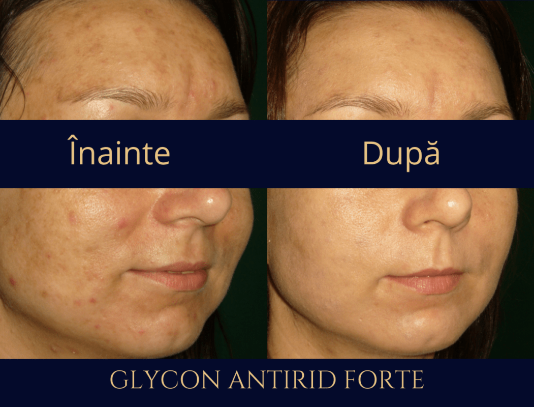 Gama de produse profesionale Glycon cu acid glicolic