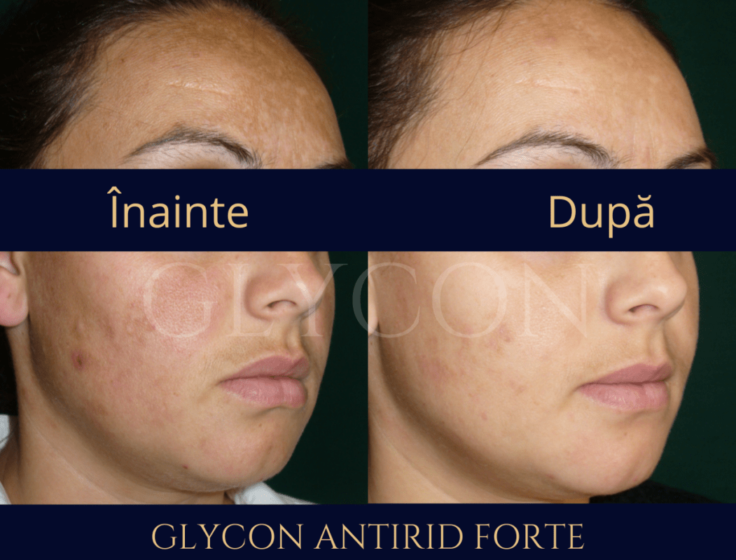 Galerie foto - Tratament Glycon