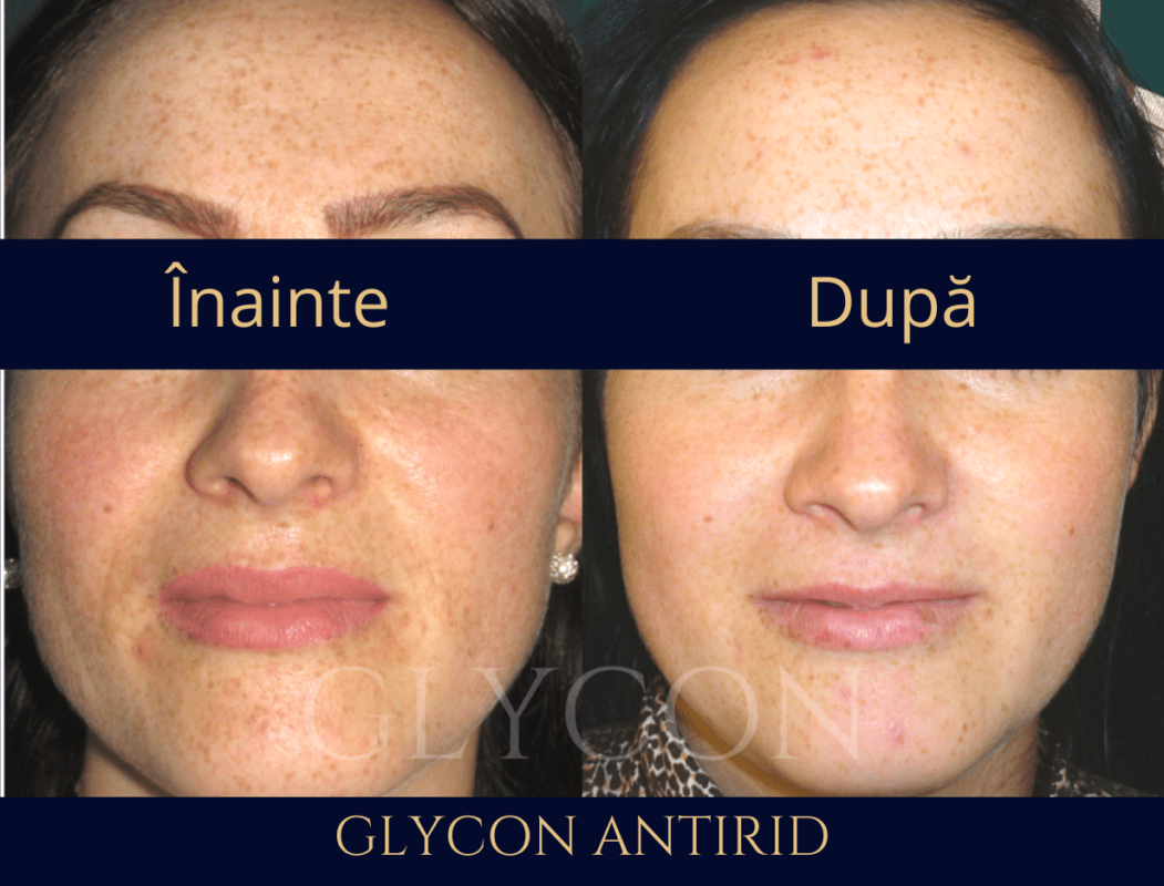 Galerie foto - Tratament Glycon