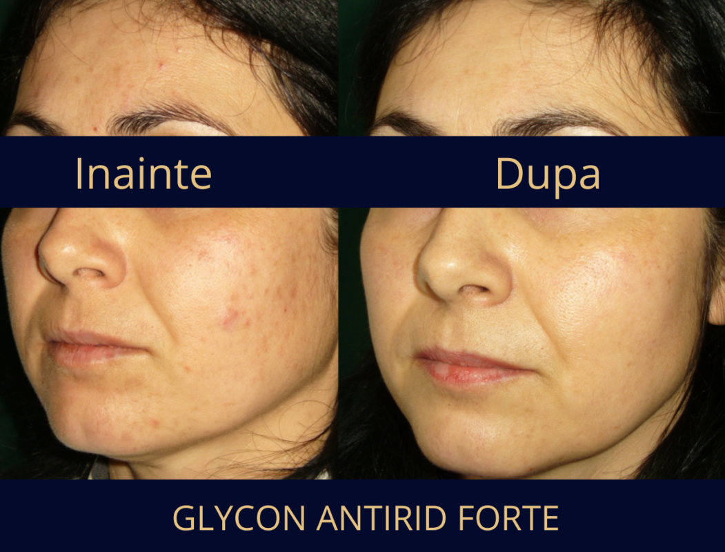 Gama de produse profesionale Glycon cu acid glicolic